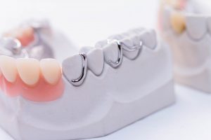 Zahnersatz (Prothetik) – Zahnarztpraxis Dr. Mühlenbeck