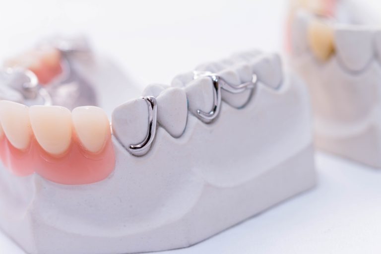 Zahnersatz (Prothetik) – Zahnarztpraxis Dr. Mühlenbeck